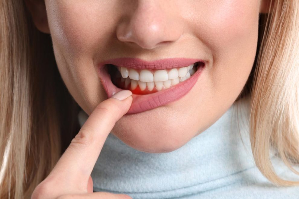 Sintomi da ascesso gengivale? Le soluzioni per curarlo meglio